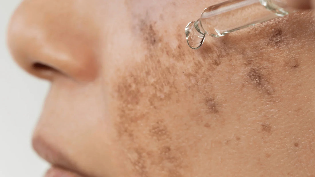 How to Fade Hyperpigmentation Without Damaging Your Skin Barrier ...